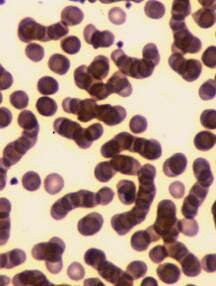 Horses and Zebras: Clinical features of Multiple Myeloma